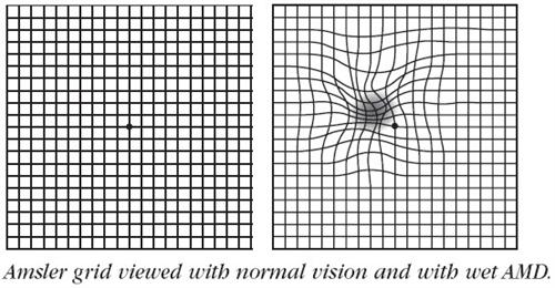 Macular Degeneration Saratoga Ophthalmology